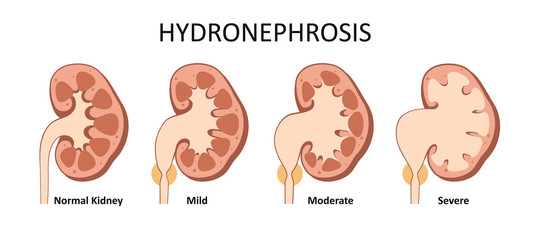 O que saber sobre hidronefrose - ABOLIÇÃO FM